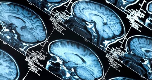 Our Parkinson's Place: A brain scan that could diagnose Parkinson's