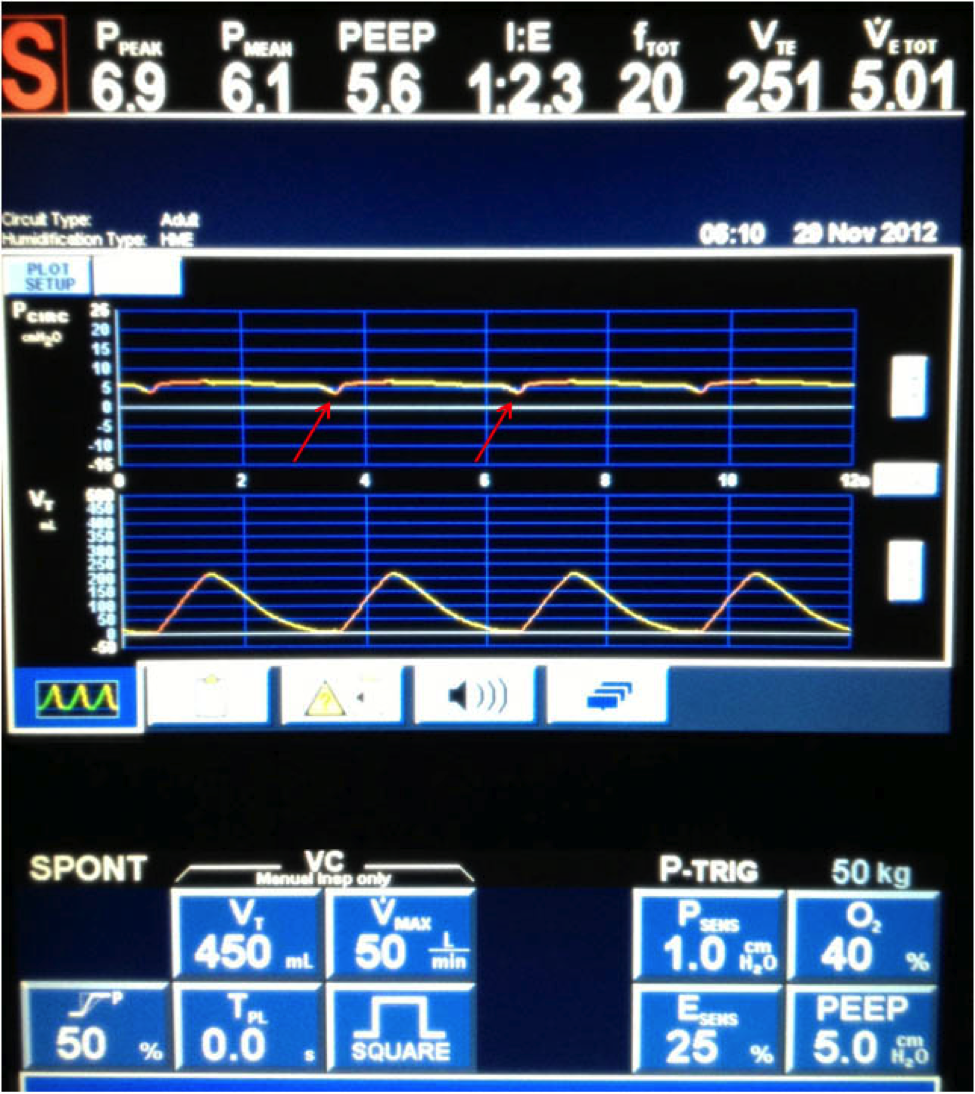 若手のための人工呼吸器ワークショップ: [アシュワース教授]人工呼吸器のモード CPAP その2