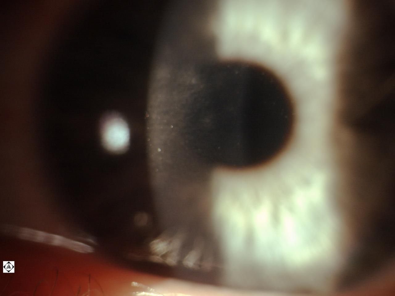 Sonoran Desert Eye Center: CORNEAL SUBEPITHELIAL INFILTRATE FROM VIRAL ...