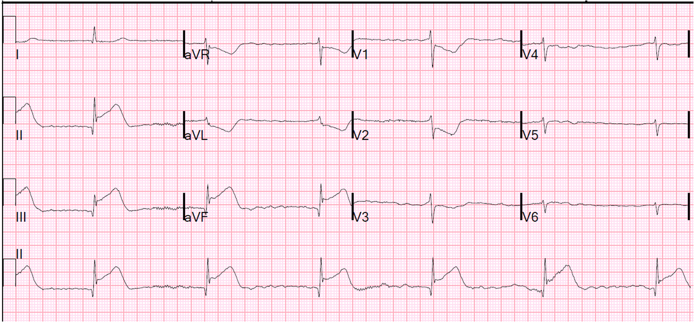 Dr. Smith's ECG Blog: Chest pain and Bradycardia
