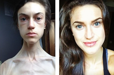 LIKE YOUR FAT ! 3 SIGNS That You Need Healthy Fat in Your Diet ...