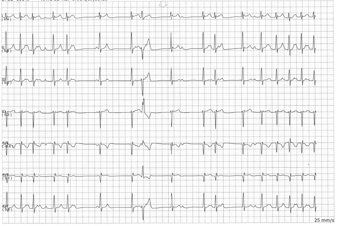 Dropped PACs and escape beats