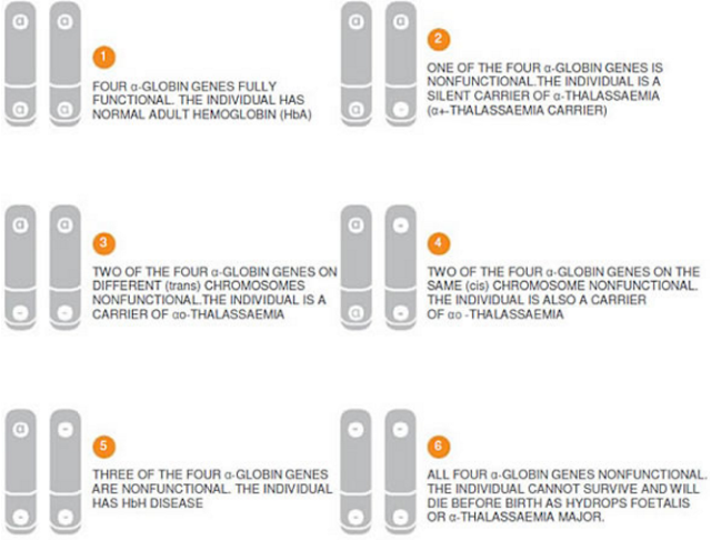 HEMOGLOBINOPATÍAS : ALFA TALASEMIAS (Por Celia J. Revilla)