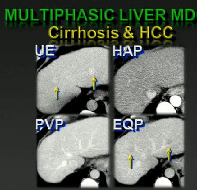 rsna: focal liver disease CT and MR technique 나중 한번 더 꼭