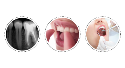 Marlon Becerra Suba: ¿Qué es una Exodoncia Simple?