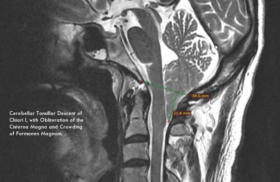 Ultimate Radiology : The Chiari I Malformation