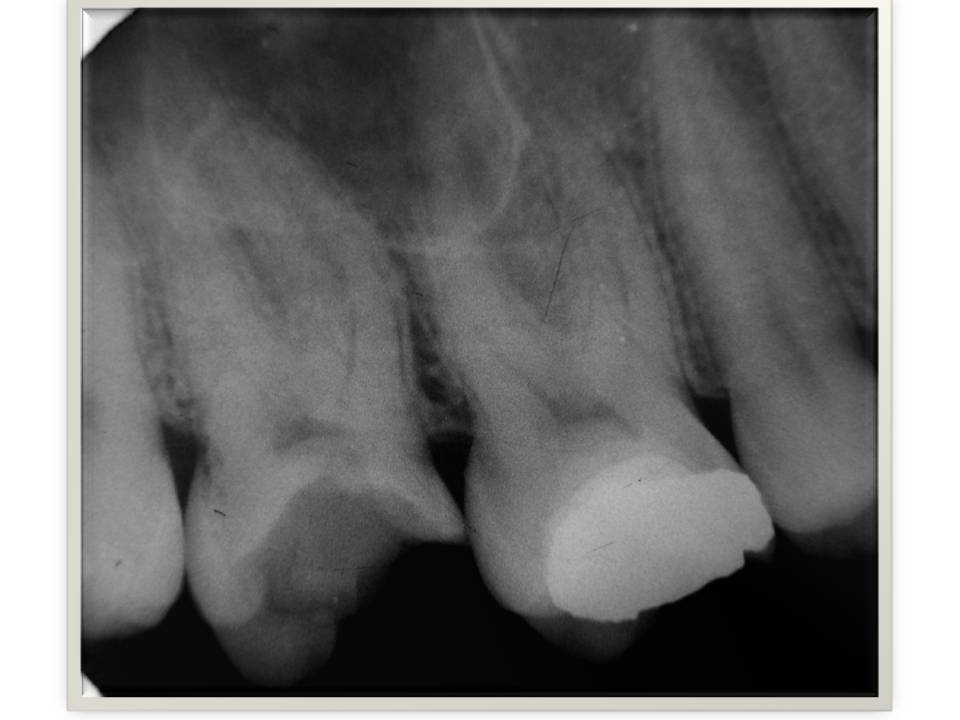 ENDODONCIA Casos Clínicos: SEGUNDO MOLAR SUPERIOR CON 4 CONDUCTOS ...