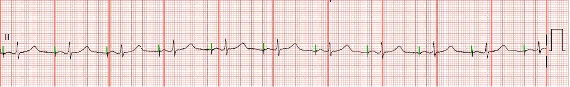 EKG Rhythm Strip Quiz 56: Paced Rhythms