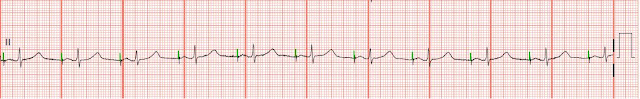 EKG Rhythm Strip Quiz 56: Paced Rhythms