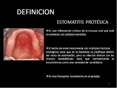 PROSTODONCIA TOTAL: Estomatitis protesica