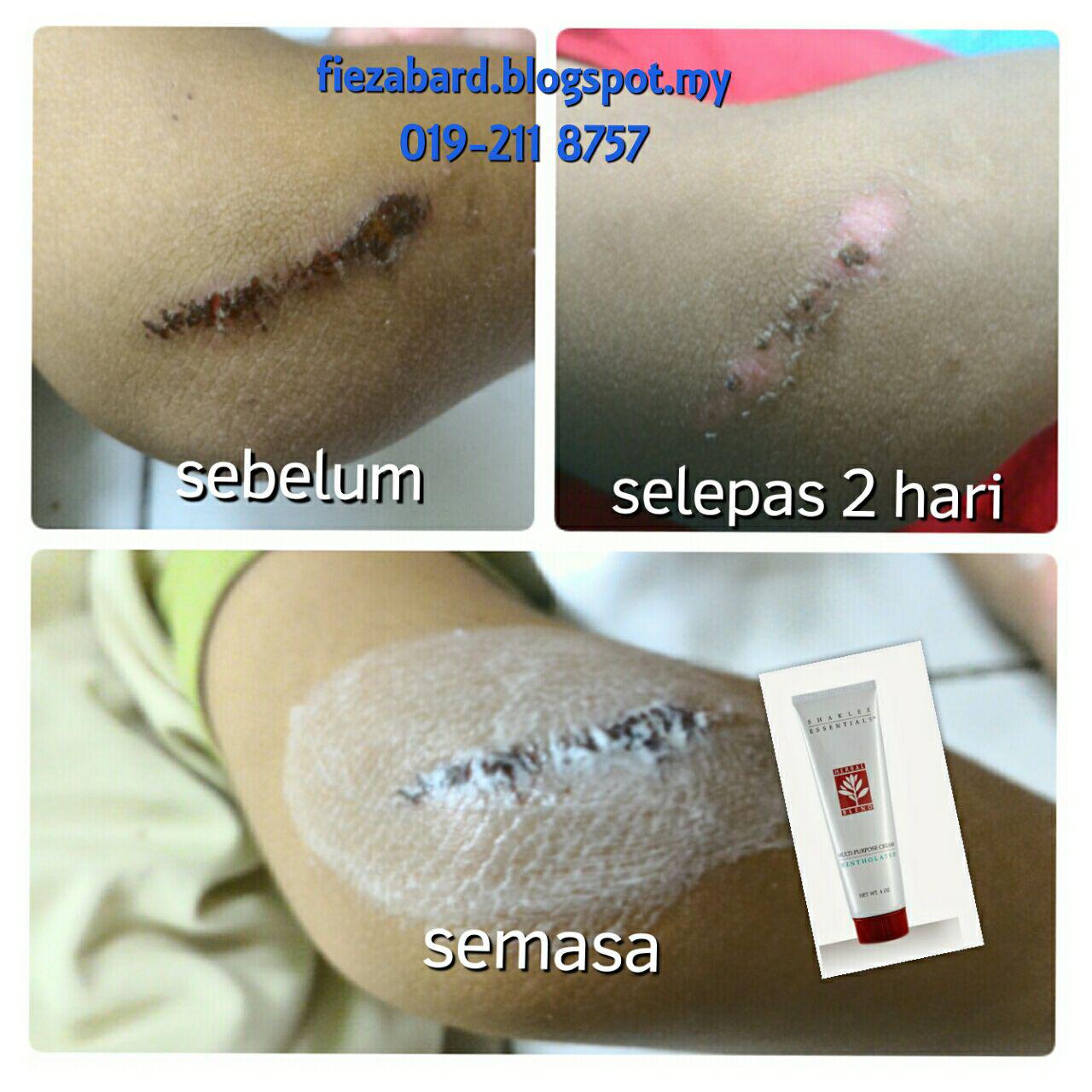 fiezaBard: CARA MENYEMBUHKAN LUKA DAN MENGHILANGKAN PARUT LUKA PALING ...