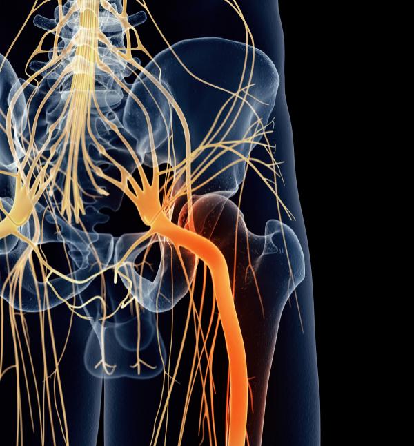 Como Se Cura El Nervio Ciatico - Remedios Naturales - Ciatica ...
