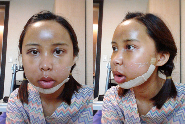 Kisah nyata operasi plastik dua rahang di RS Wonjin: Prin