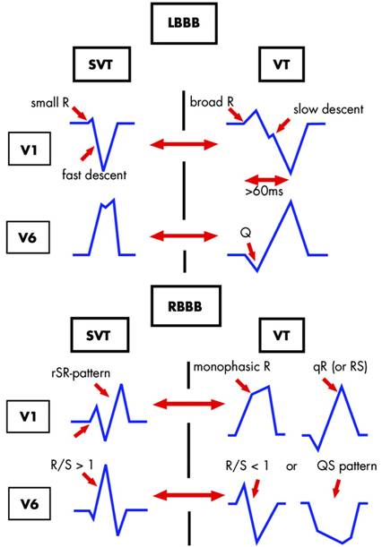 Cardiology window: SVT with aberrancy