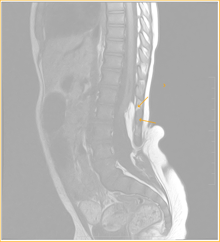 Intradural Lipoma with cutaneous dermal sinus-MRI - Sumer's Radiology Blog