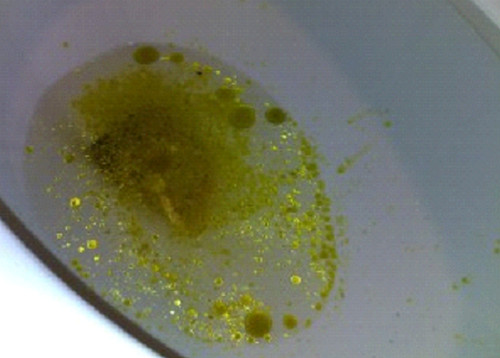 What is Steatorrhea - Pictures, Symptoms, Causes, Treatment