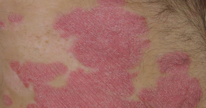 Que Es Bueno Para La Psoriasis y Sus Sintomas - Psoriasis Tratamiento ...