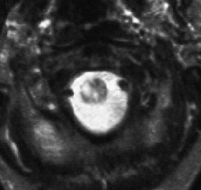 NeuroAnatomía Dr. William Ganem: Romboencefalitis por Listeria ...