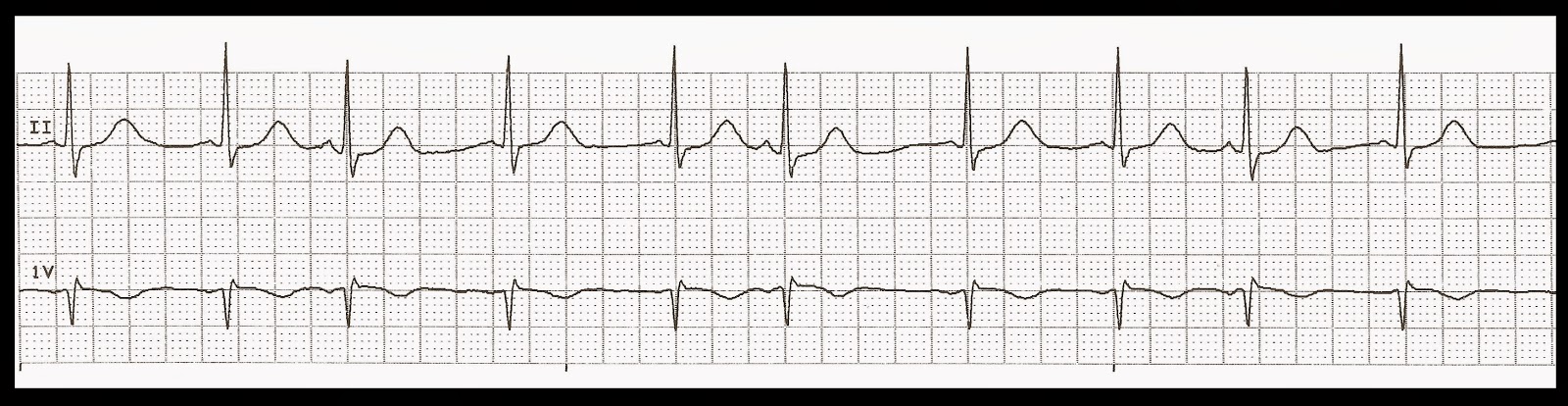 Practice EKG Strips 393