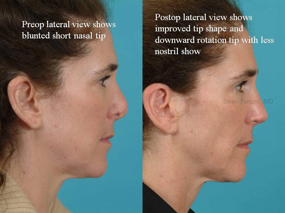 Dr. Dean Toriumi Reviews: Dean Toriumi Reviews: Severe nasal tip ...