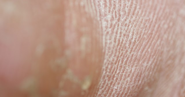 VittoriFootAnkleSpecialist: Heel Fissures and Calluses