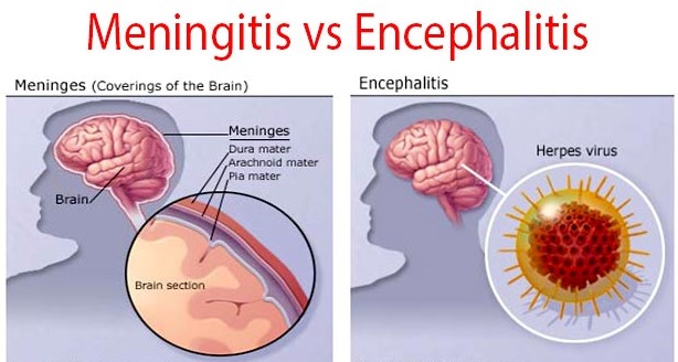 Encephalitis What Are The Symptoms And How Can It Be