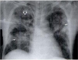 Análisis de placa de torax: BRONQUIOLITIS, BRONCONEUMONÍA Y NEUMOTORAX