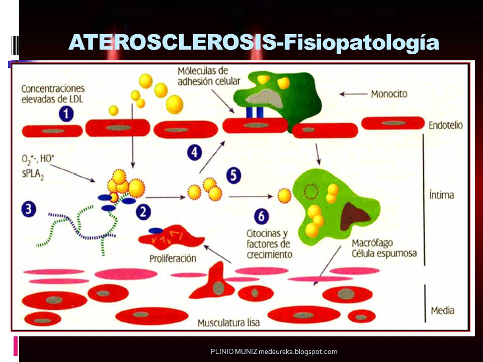 Eureka: Aterosclerosis