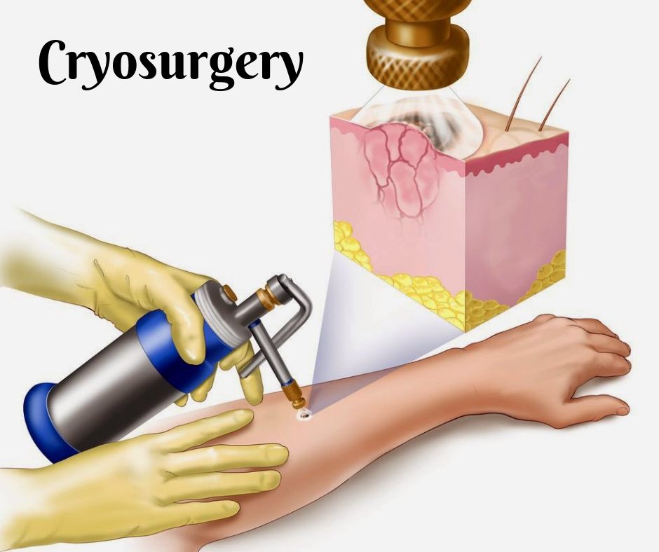 2nd World Congress on Surgeons: Cryosurgery