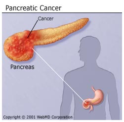Apothegmatic Summary of Typical Signs Tied to Pancreatic Cancer ...