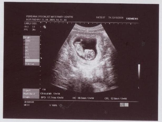 ღFashyaMusaღ: Pertama Dan Kedua @12 weeks