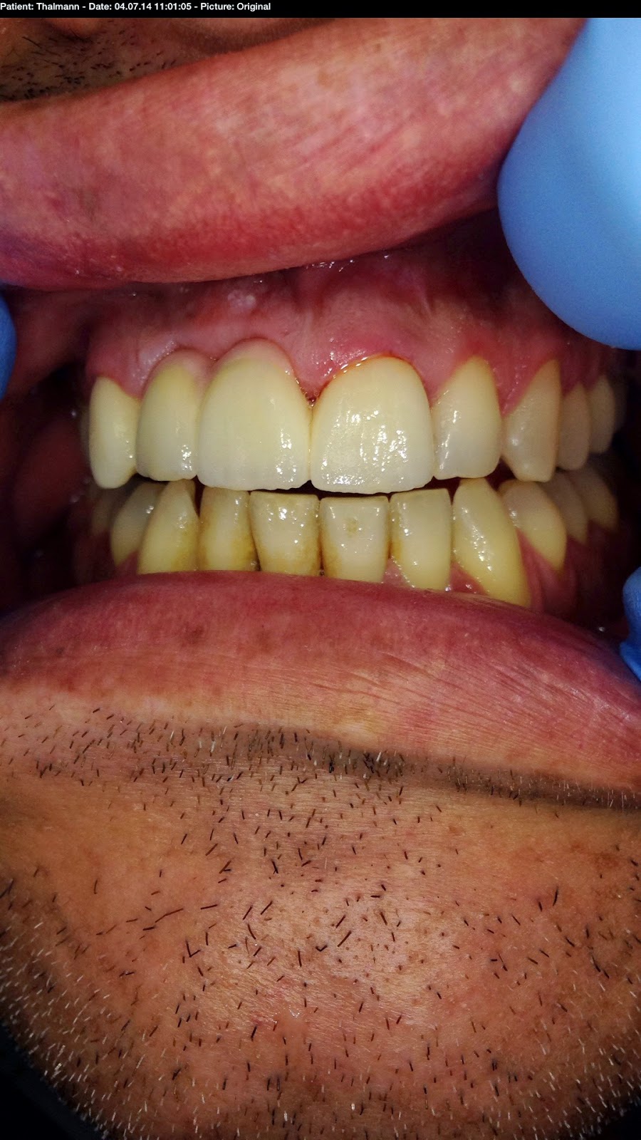 Zahnmedizin und Technik: Die Zirkon Krone oder VMK Krone