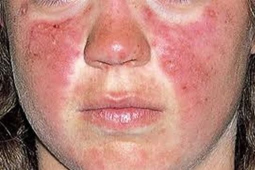 HistoPatologias: POLIOMIOSITE E DERMATOMIOSITE