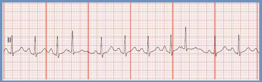 EKG Rhythm Strip Quiz 156