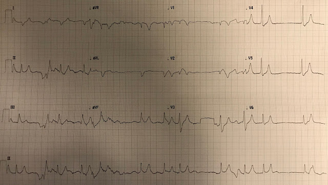 Dr. Smith's ECG Blog: Grouped Beating, What is it?