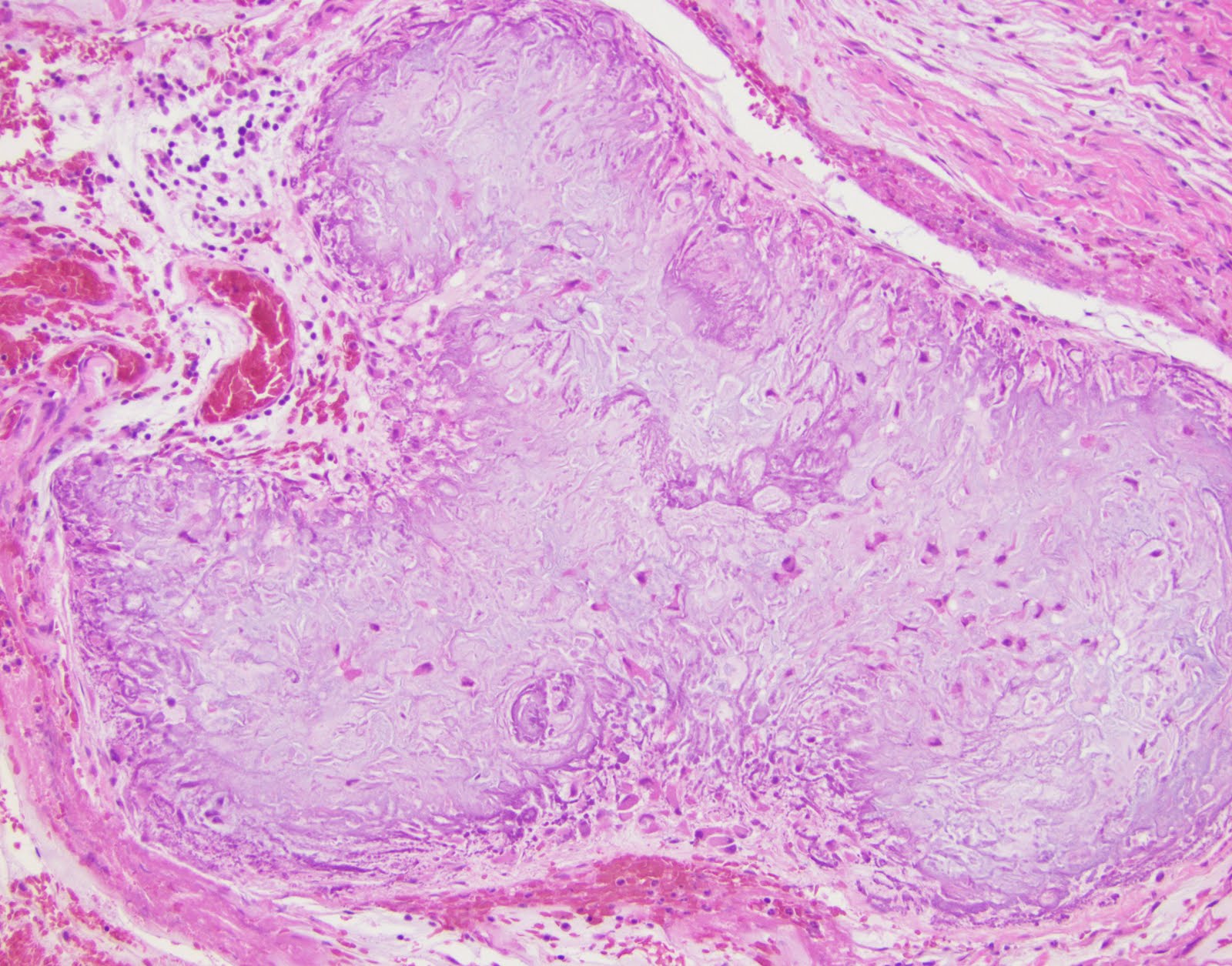 neuropathology blog: Best Post of November 2016: Calcifying ...