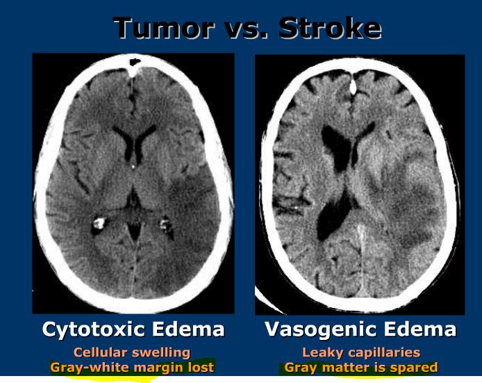 Internship.preparation: vasogenic vs Cytotoxic Edema