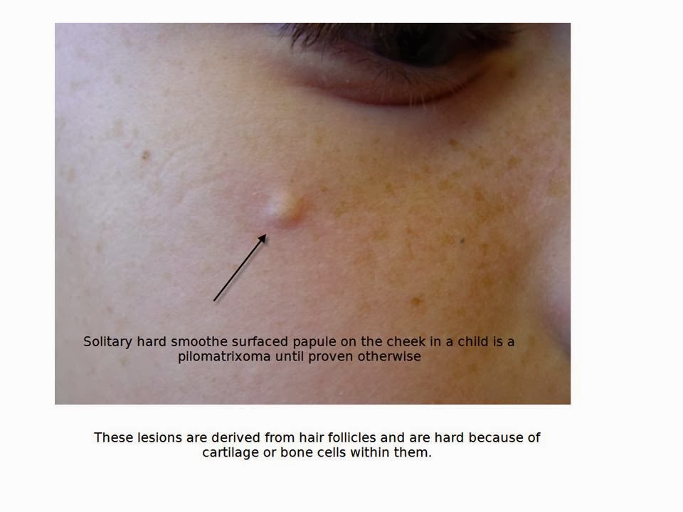Dermpath Made Simple - Neoplastic: Pilomatrixoma