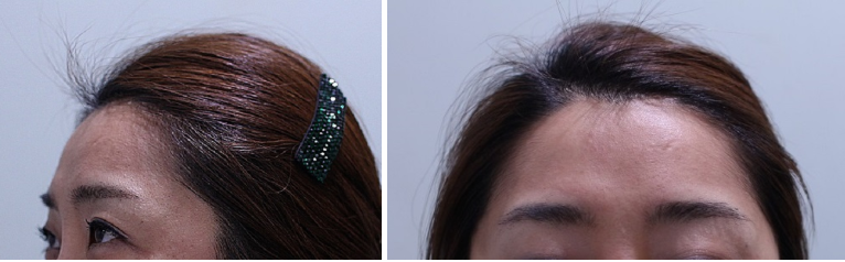 Renewme Skin Clinic: Patient review for Forehead Filler