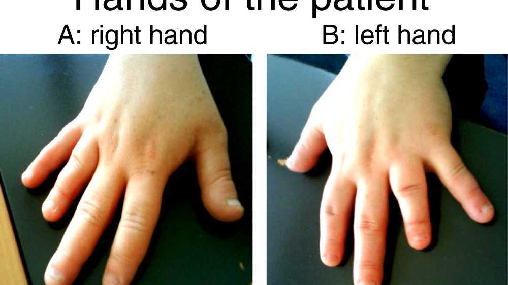 Albright's hereditary osteodystrophy