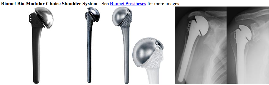 Shoulder and Elbow Surgery: Identifying the implanted shoulder ...