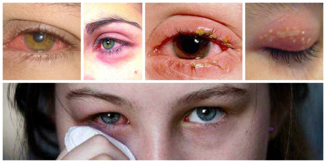 Saúde do Adulto: Blefarite