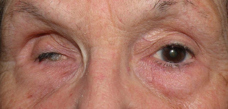 Phthisis Bulbi : Causes, Symptoms, Stages, Prognosis and Treatment