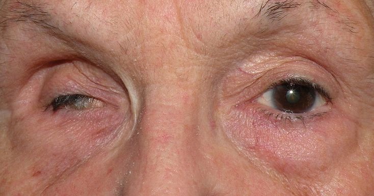 Phthisis Bulbi : Causes, Symptoms, Stages, Prognosis and Treatment