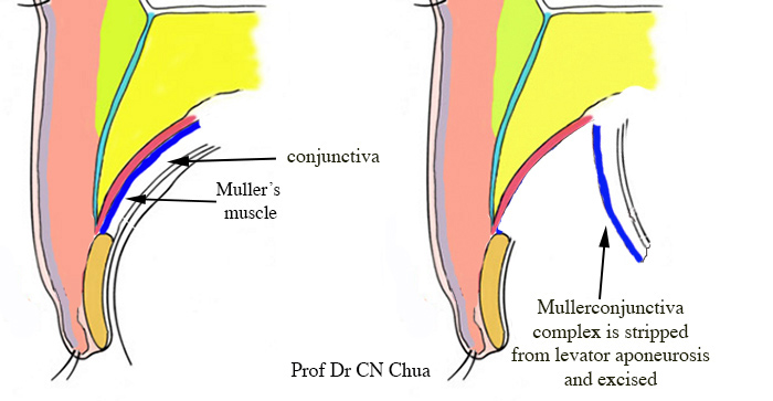 Eyelid Surgery by Prof Dr CN CHUA 蔡鐘能: Doc, Could You Balance My Eyes ...