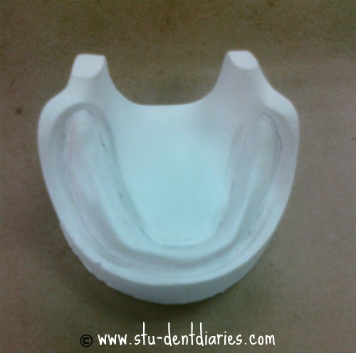 Stu-DENT Diaries: Custom Tray, Record Base and Wax Rim