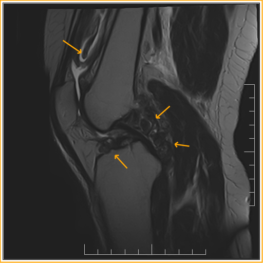 Pigmented villonodular synovitis : MRI - Sumer's Radiology Blog