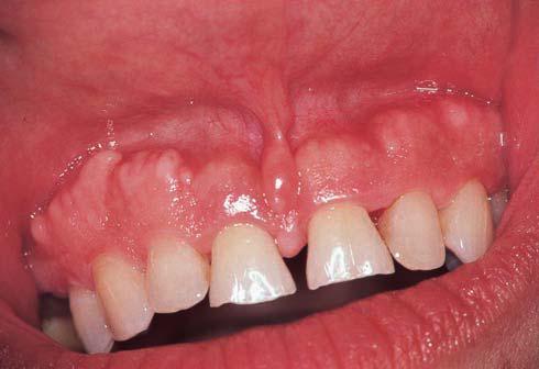 Dentistry lectures for MFDS/MJDF/NBDE/ORE: A Note on Bone Swellings in ...