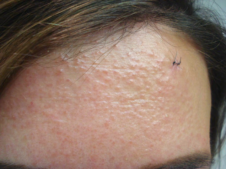 VIRTUAL GRAND ROUNDS IN DERMATOLOGY 2.0: Granulomatous Rosacea