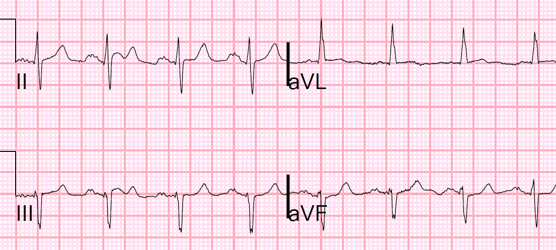 Dr. Smith's ECG Blog: A Middle-Aged Man with crescendo angina